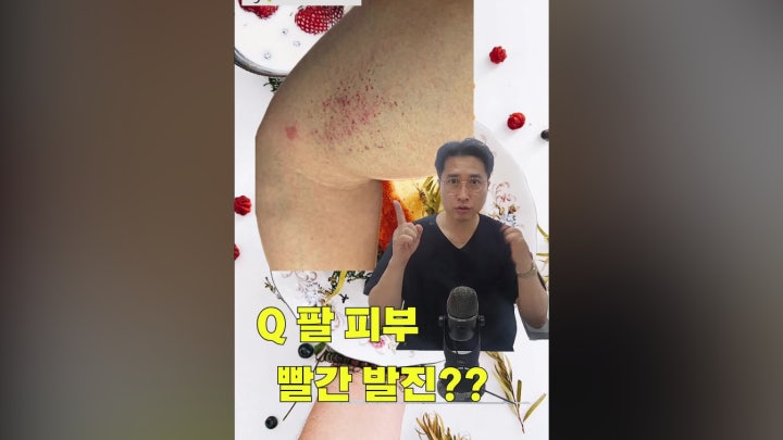 Q227_팔피부빨간발진 자다 일어나니까 팔에 이렇게 붉은 발진처럼 올라와있던데 ㅜㅜㅜ 왜 - 네이버 TV