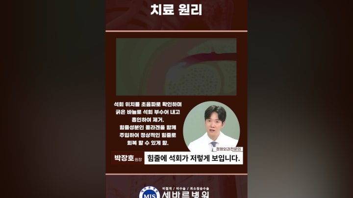 석회성 건염을 치료 하는 석회분쇄흡인술 치료는 어떻게 진행될까 네이버 Tv