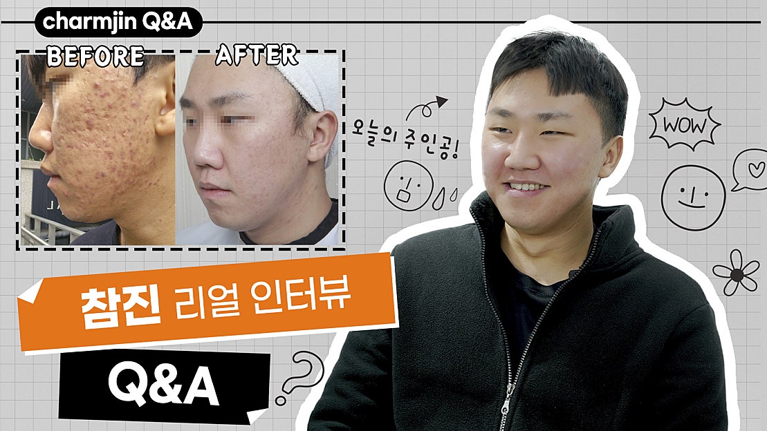 여드름 흉터 치료 후기 참진 리얼 인터뷰 🔥한 달 만에 고민 해결 인터뷰 여드름 흉터 인터뷰영상 네이버 Tv