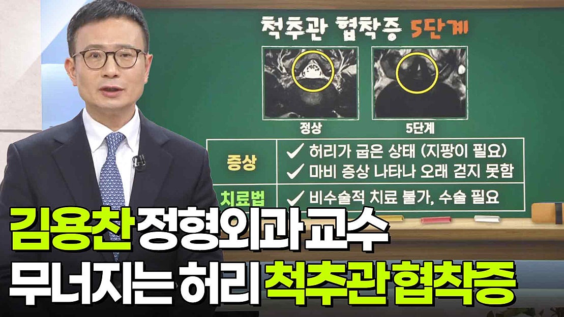 김용찬 정형외과 교수, 무너지는 허리 척추관 협착증 | KBS 250327 방송 - 네이버 TV