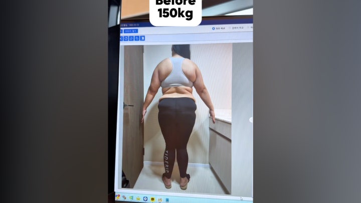 64kg 감량 후 처진살은?? - 네이버 TV