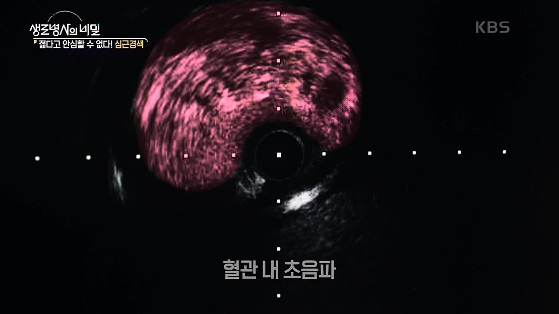 젊다고 안심할 수 없다! 심근경색 | KBS 250521 방송 - 네이버 TV